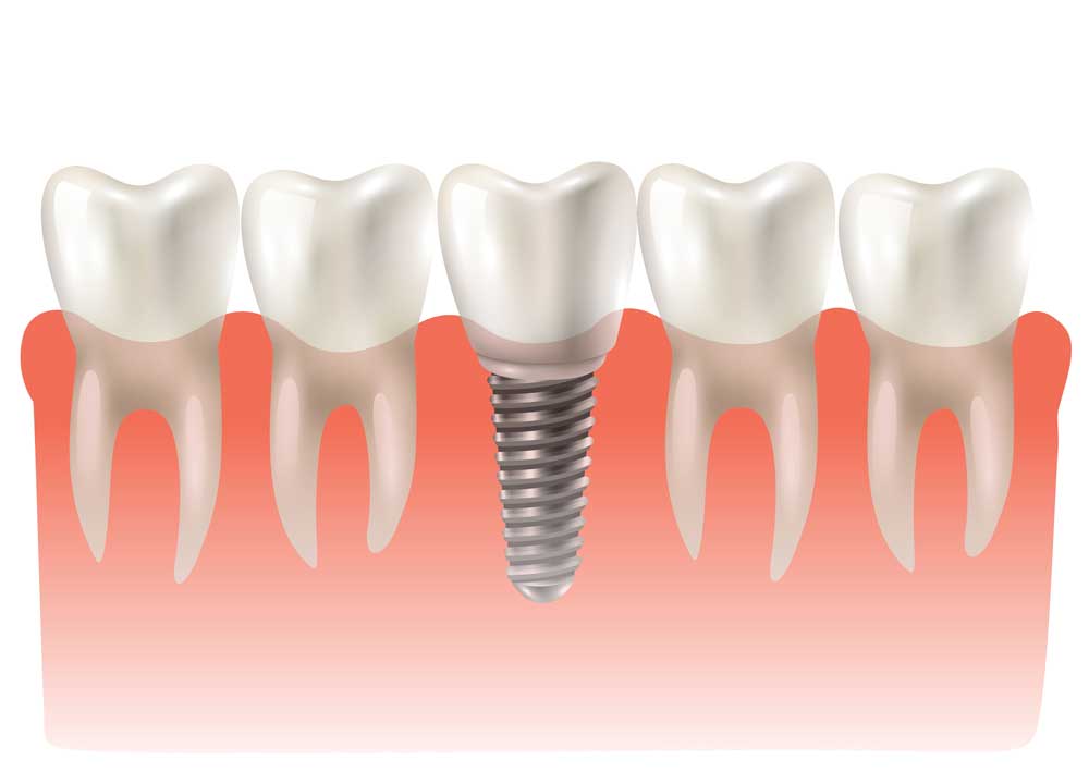Dental Bridge vs Implant: Cost Benefits & Longevity Compared