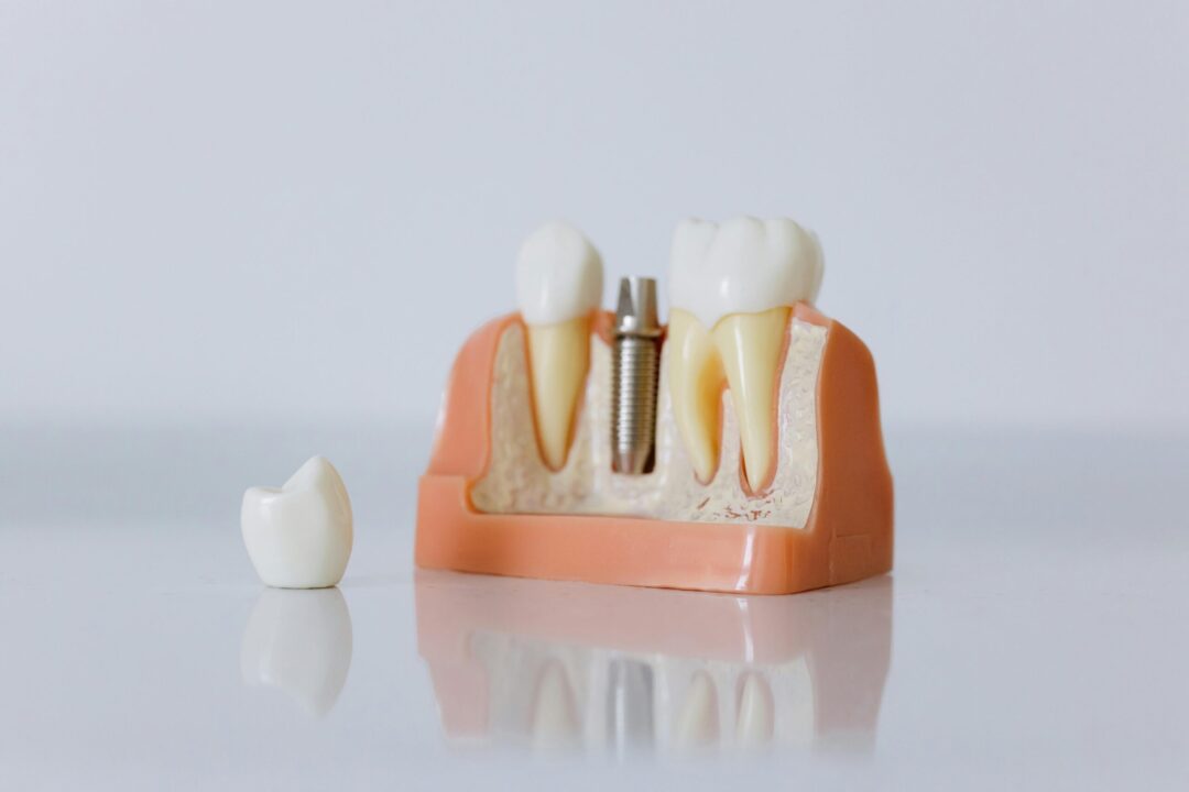 Dental Implants Cost Guide Australia 2026 | DentistsCost